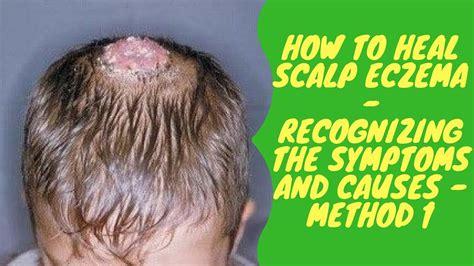 Eczema Symptoms Scalp At Numbers Mcleod Blog