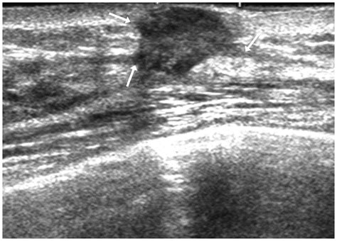 Sonographic Appearance Of A 44 Year Old Woman With Nodular Breast