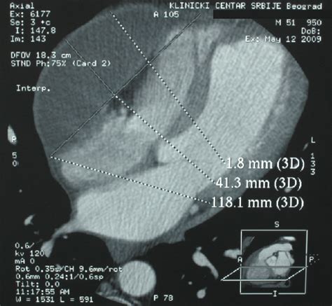 Computed Tomography Demonstrating A Large Loculated Post Infarction