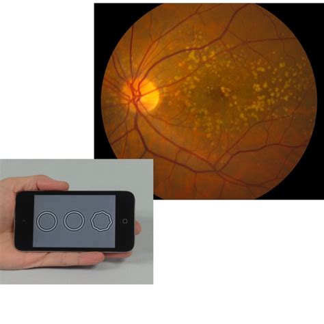 Visual Function In Eyes With Intermediate Amd With And Without Retinal