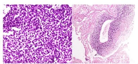 Histologic Findings 2a On The Left Round Tumor Cells Exhibiting