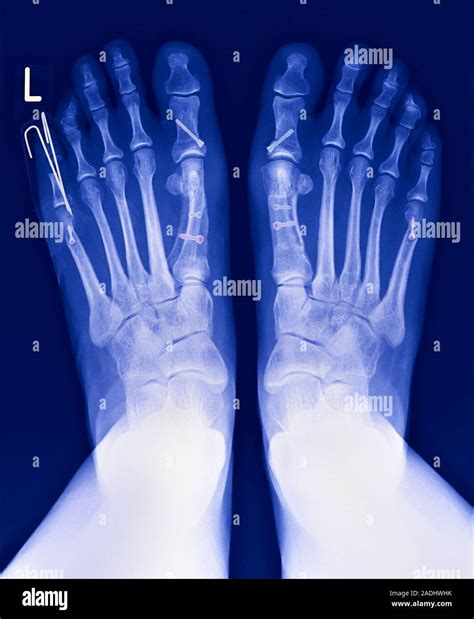 X Ray Big Toe