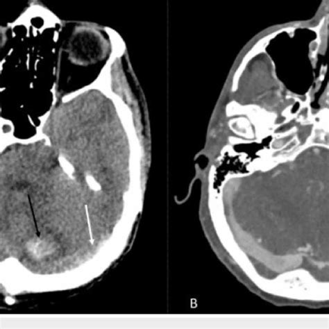 Axial Non Contrast Ct And Ct Venogram Of Head A Axial Non Contrast Ct
