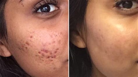ESSE TRATAMENTO FACIAL REMOVE ATÉ CICATRIZES YouTube