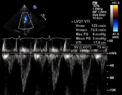 Lvot Vti Calculated By Obtaining A 5 Chamber Apical View And Using A