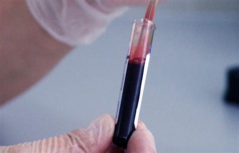 Diferencias Entre Hipocalcemia E Hipercalcemia Sooluciona