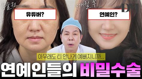 연예인들의 비밀 수술 안면거상💦 안면거상 리프팅 성형정보 Youtube