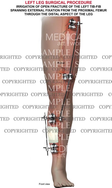 Broken Tib Fib External Fixator On