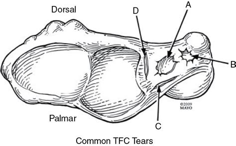 Repairing Tears Of The Triangular Fibrocartilage Complex Clinical Tree