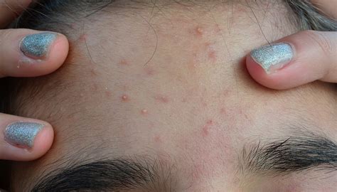 Puberdade precoce dá 5 sinais em meninos e meninas e afeta até o humor