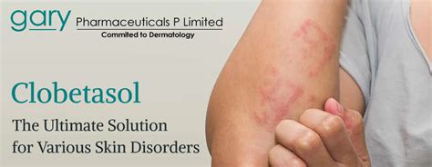 Clobetasol The Ultimate Solution For Various Skin Disorders