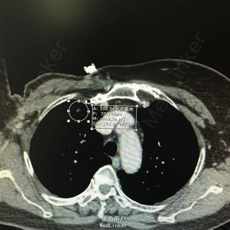 右侧乳腺癌术后3月，伴右上肺原发浸润性腺癌一例 医联