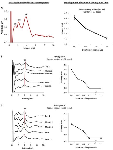A Example Of An Electrically Evoked Auditory Brainstem Response