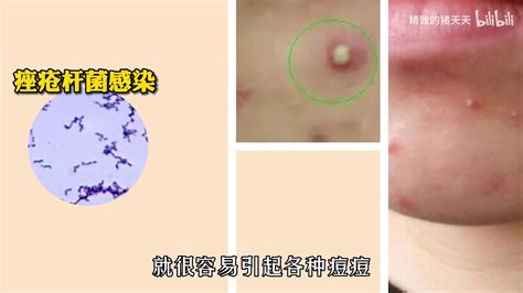 痘痘反复长？小心烂脸！ 拯救烂脸三部曲”快接收！️快速解决顽固痘根 哔哩哔哩