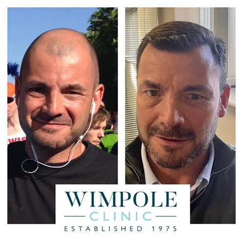 Are Hair Transplants Worth It Wimpole Clinic
