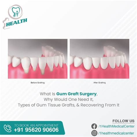 What Is Gum Graft Surgery Why Would One Need It Types Of Gum Tissue Grafts And Recovering From It
