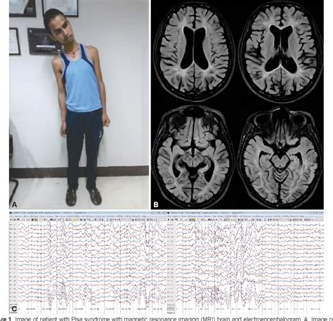Figure 1 From Pisa Syndrome In Subacute Sclerosing Panencephalitis A