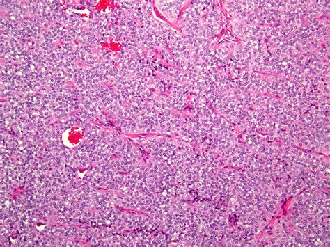 Pathology Outlines Solid Pseudopapillary Neoplasm