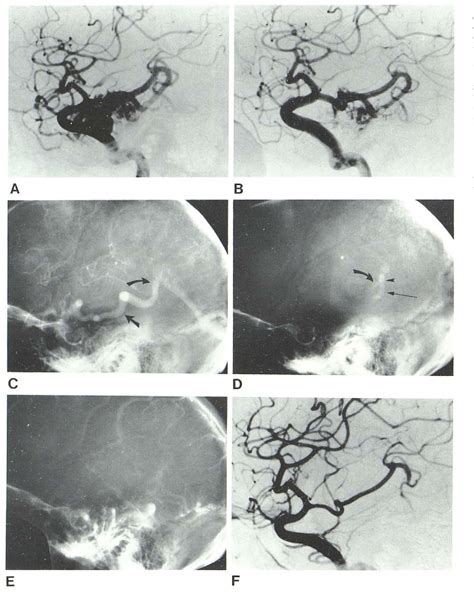 Figure 1 From Progressive Thrombosis Of Brain Arteriovenous