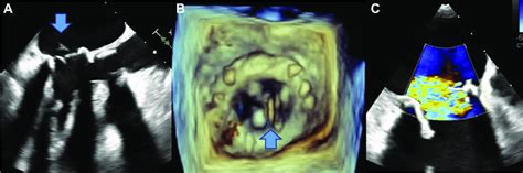 A B Intraprocedural Tee Confirming The Flail Mitral Valve Leaflet