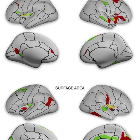Spatial Overlap Between Decreases In Cortical Thickness And Surface
