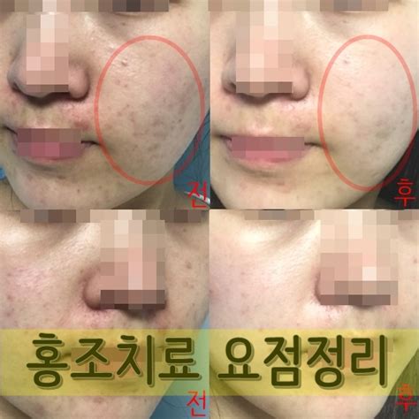 예작화장품 안면홍조의 원인과 치료 그리고 리얼 극복기 홍조가 사라졌다 항상 붉은 분들 냉큼 오세요 네이버 블로그