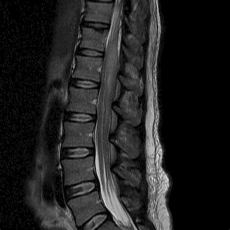 Mri Lumbar Thoracic Spine With Contrast Showing Large Lumbar Intradural