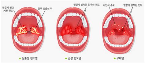 편도 부었을때 타이레놀 효과는 편도염 빨리 낫는 방법