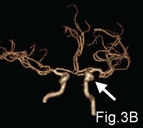A C Show The Mra Cta And 3d Dsa Respectively Of The Left Internal