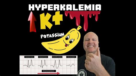 Why Hyperkalemia Causes A Widened Qrs Complex On The Ecg Explained Youtube