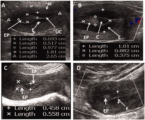 Uterine Cavity Ultrasound