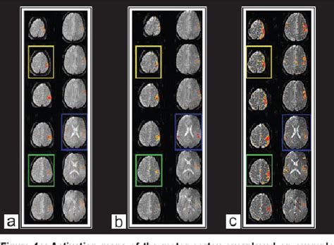 Figure 1 From Ultrafast Bold Fmri Using Single Shot Spin Echo Echo