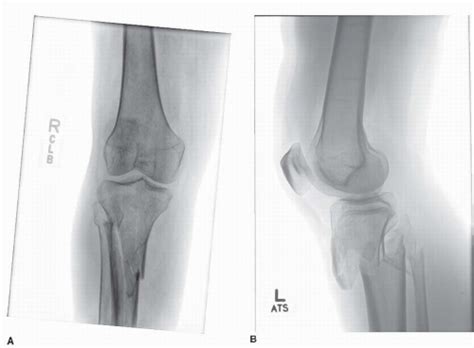 Extra Articular Proximal Tibial Fractures Submuscular Locked Plating Musculoskeletal Key