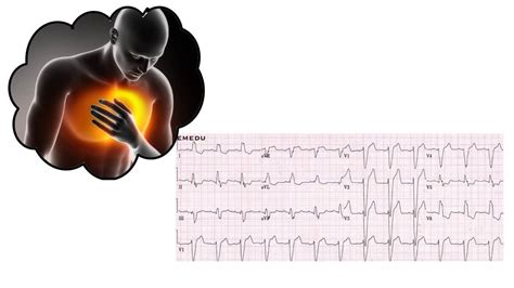 Você sabe identificar IAM na vigência de BRE CardioSite