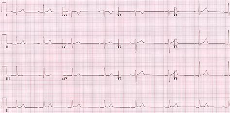 Beta Blockers Intoxication ECG Book