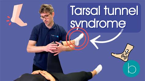 Tarsal Tunnel Syndrome Everything You Need To Know Youtube