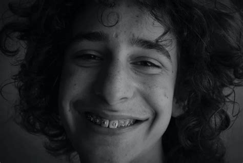 How To Avoid Braces In Orthodontics