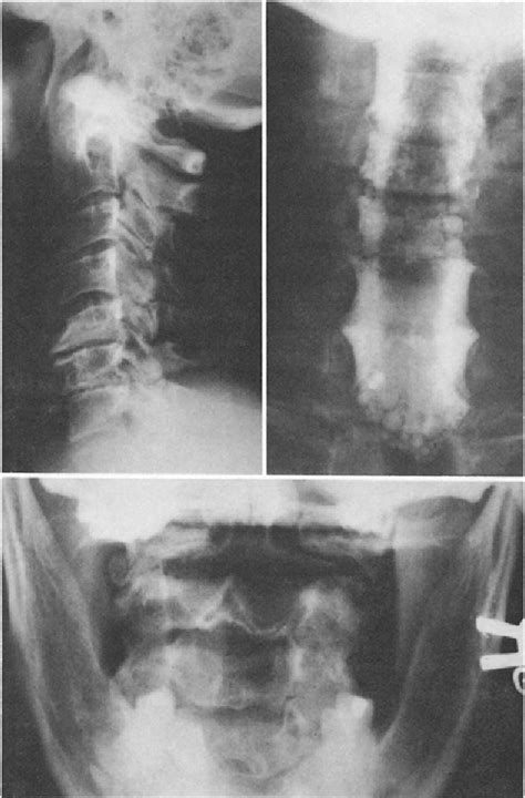 Figure 1 From Occipital Neuralgia And The C1 2 Arthrosis Syndrome Semantic Scholar
