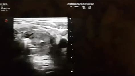 [video] Learn The Rfa Procedure By Thermoablating The Lower Half Of The Nodule Respecting The