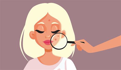 Rosacea What Is Causes Risk Factors Treatment And Prevention