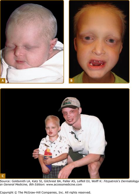 Ectodermal Dysplasias Plastic Surgery Key