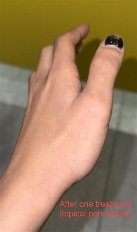 Allergic Reaction To Topical Permethrin Rscabies
