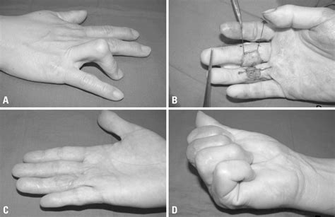 Hand Exercises For Contractures At Bridget Powers Blog