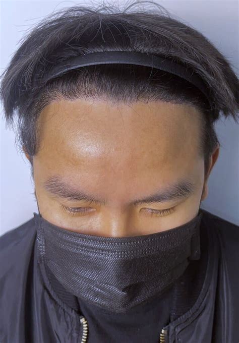 Review Cases Thai Customer 29 Years Old Mp Hair Clinic