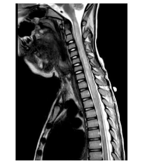 Sagittal T2 Weighted Mri Showing Hypo Intensity Spanning From The