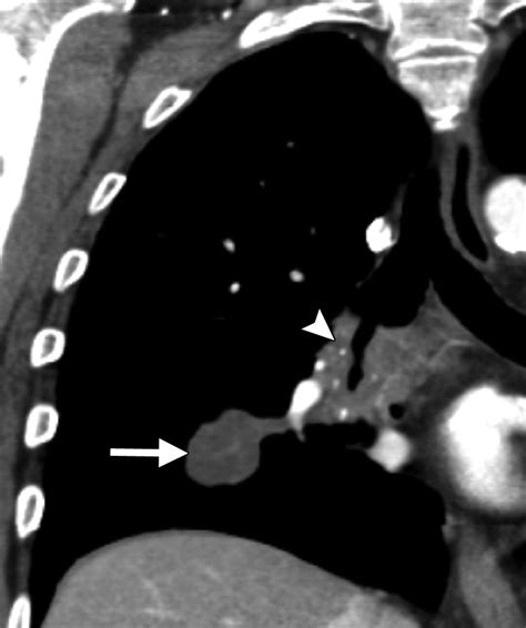 Revisions To The Tnm Staging Of Nonsmall Cell Lung Cancer Rationale