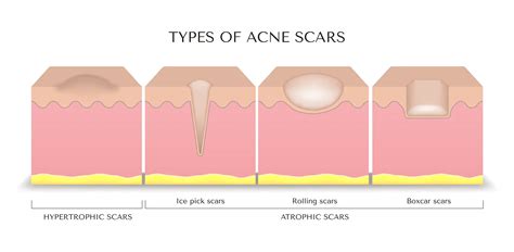 Acne Scar Removal London Arturo Grooming And Aesthetics