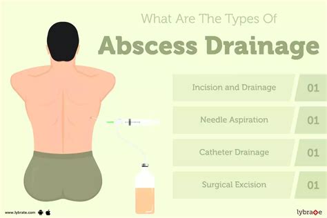 Types Of Internal Abscess All Types Of Abscesses Ping