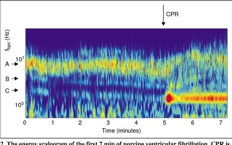 figure 2 from evaluating arrhythmias in ecg signals using wavelet
