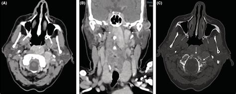 A Contrast‐enhanced Axial Ct Scan Demonstrates Two Ill‐defined